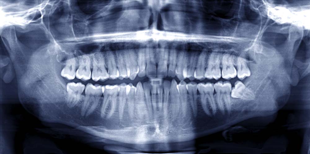 Extraction des dents de sagesse - Clinique Dentaire Victoriaville